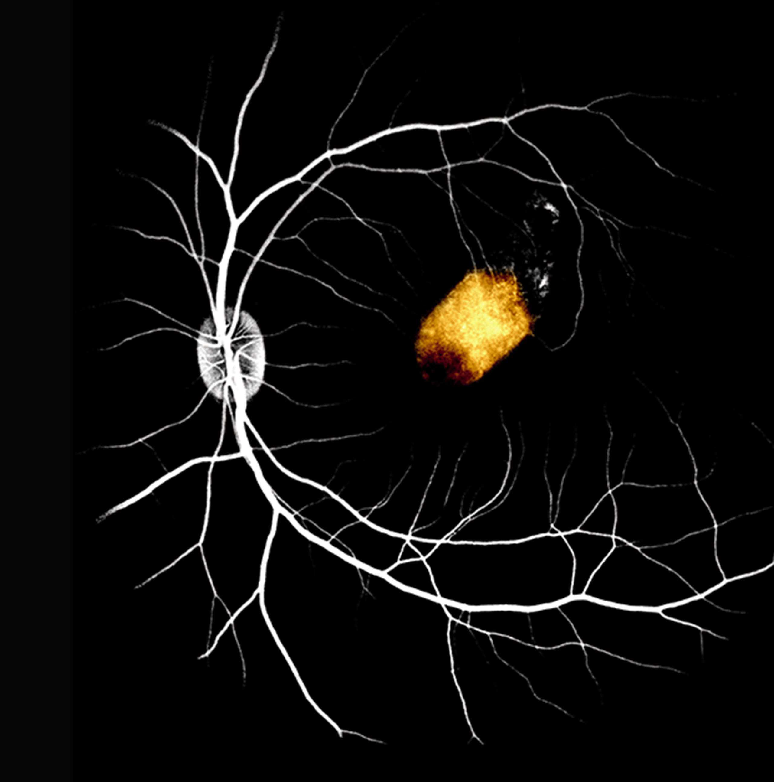 Ophthalmology Research | Icahn School of Medicine