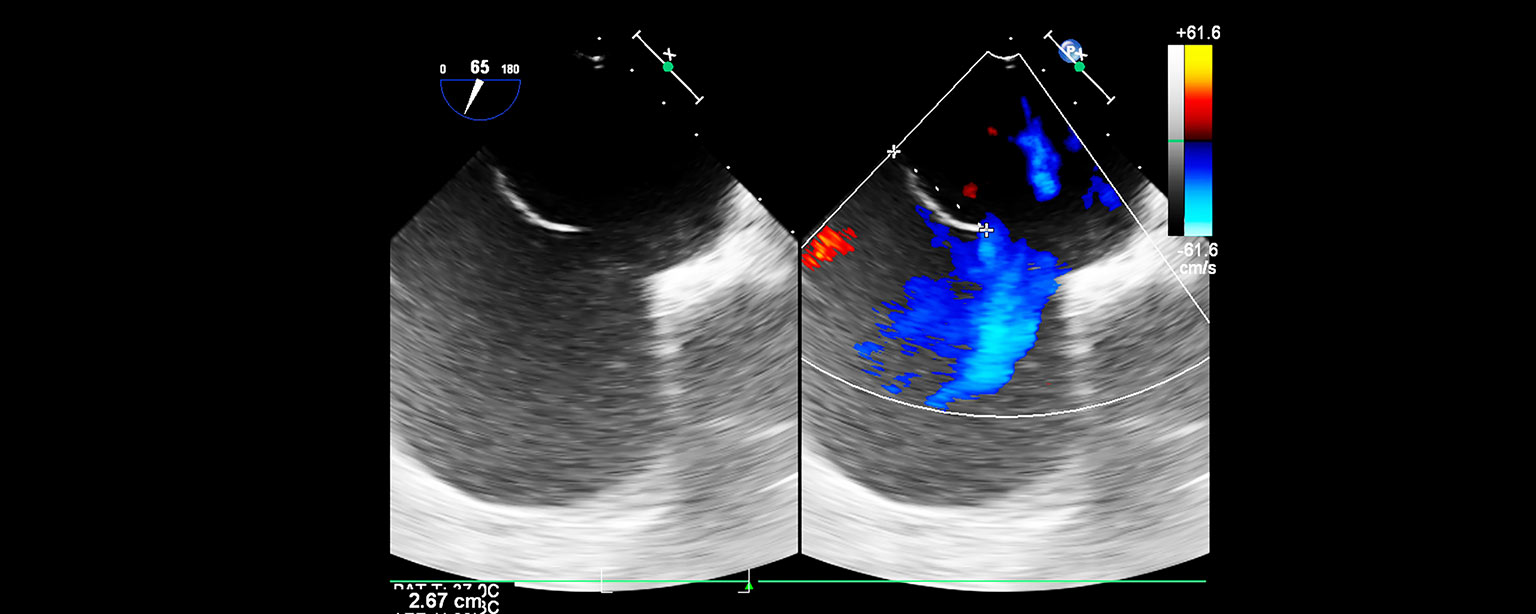 Structural Heart Interventions Imaging Fellowship | Icahn School of ...