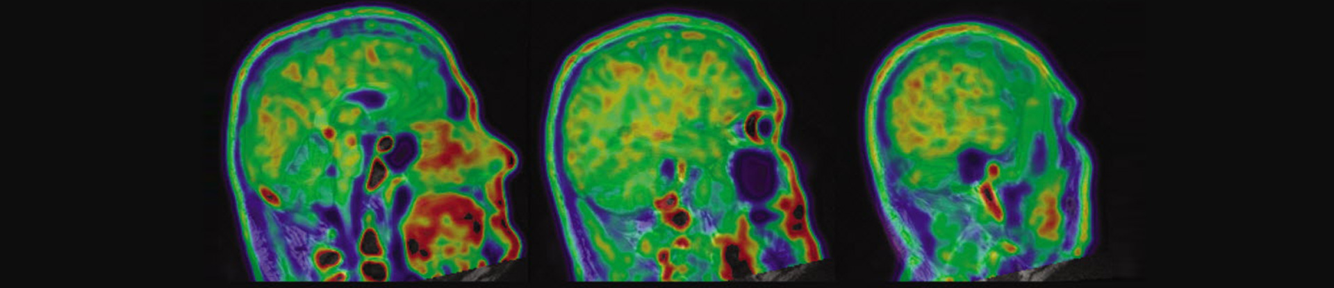 Brain Injury Research Center Research | Icahn School of Medicine