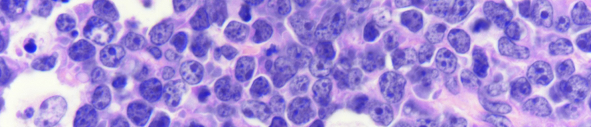 MSH Hematopathology Fellowship | Icahn School of Medicine