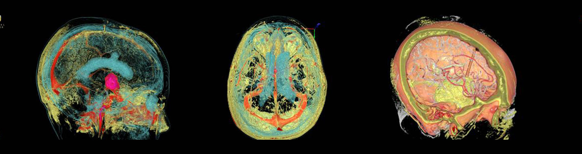 Brain Injury Research Center FAQs | Icahn School of Medicine